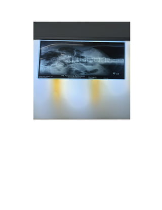 Lapkas Ulkus Gaster-dr.Teguh Rinjaya.pdf