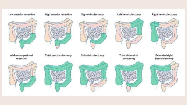 Laparoscopic Low Anterior resection.pptx | Digestive Disorders ...