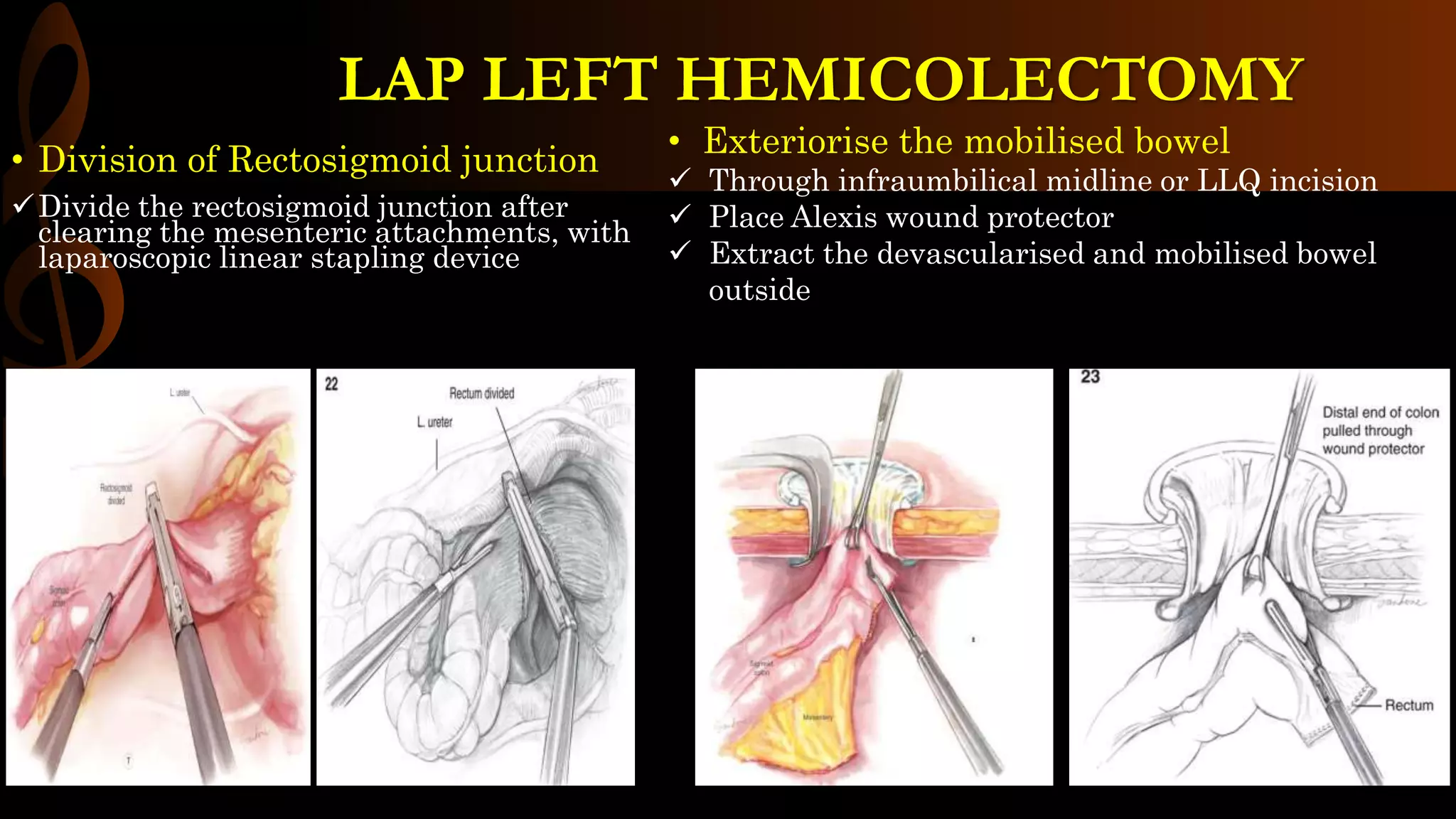 LAP LEFT HEMICOLECTOMY-STEP BY STEP Operative Surgery.pptx