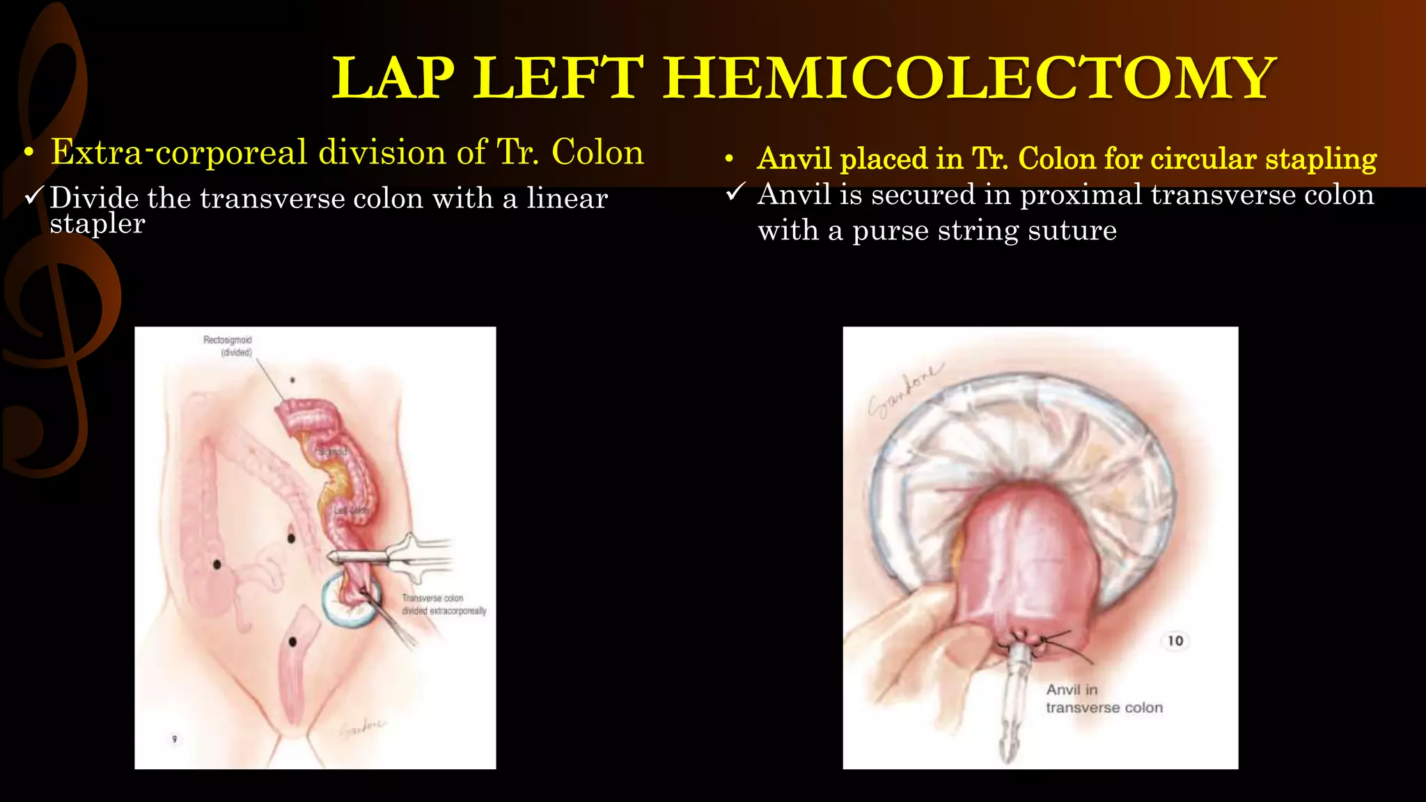 LAP LEFT HEMICOLECTOMY-STEP BY STEP Operative Surgery.pptx