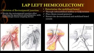 LAP LEFT HEMICOLECTOMY-STEP BY STEP Operative Surgery.pptx