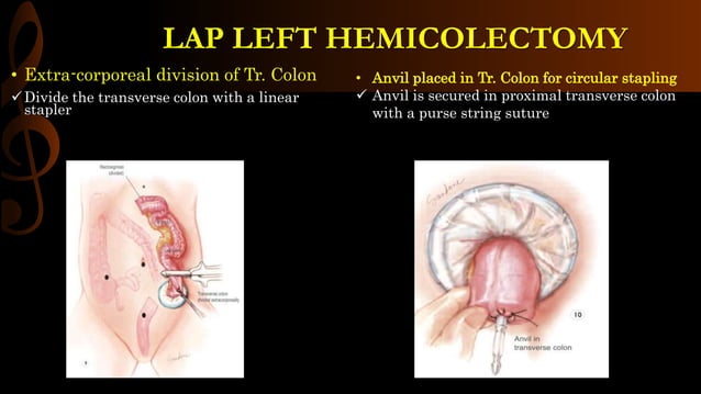LAP LEFT HEMICOLECTOMY-STEP BY STEP Operative Surgery.pptx