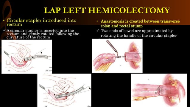 LAP LEFT HEMICOLECTOMY-STEP BY STEP Operative Surgery.pptx