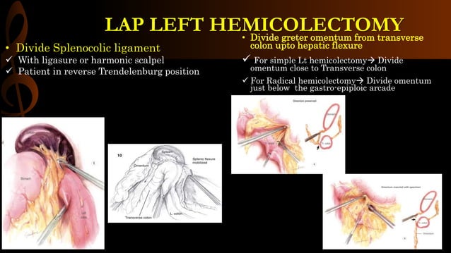 LAP LEFT HEMICOLECTOMY-STEP BY STEP Operative Surgery.pptx