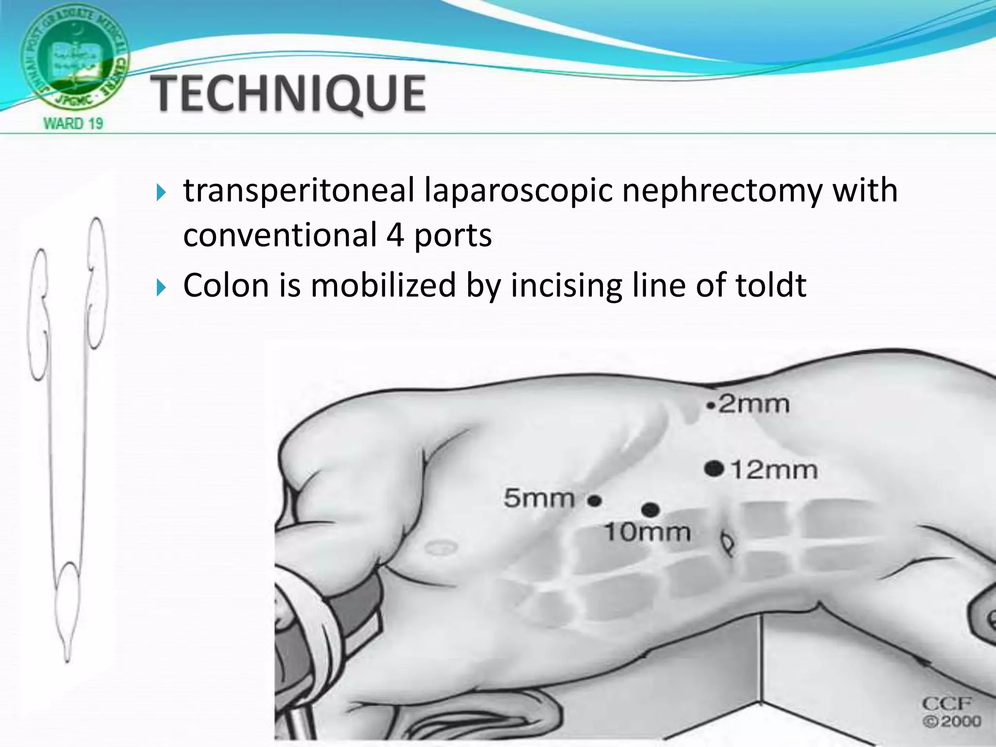 Lap nephrectomy case ppt | PPTX
