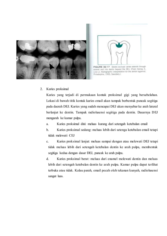 karies gigi. pemeriksaan penunjang dan tes vitalitas | DOCX