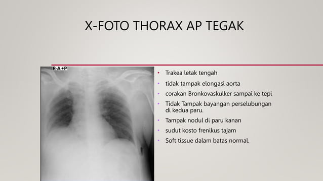 Laporan Jaga Ca Mammae sinistra.pptx