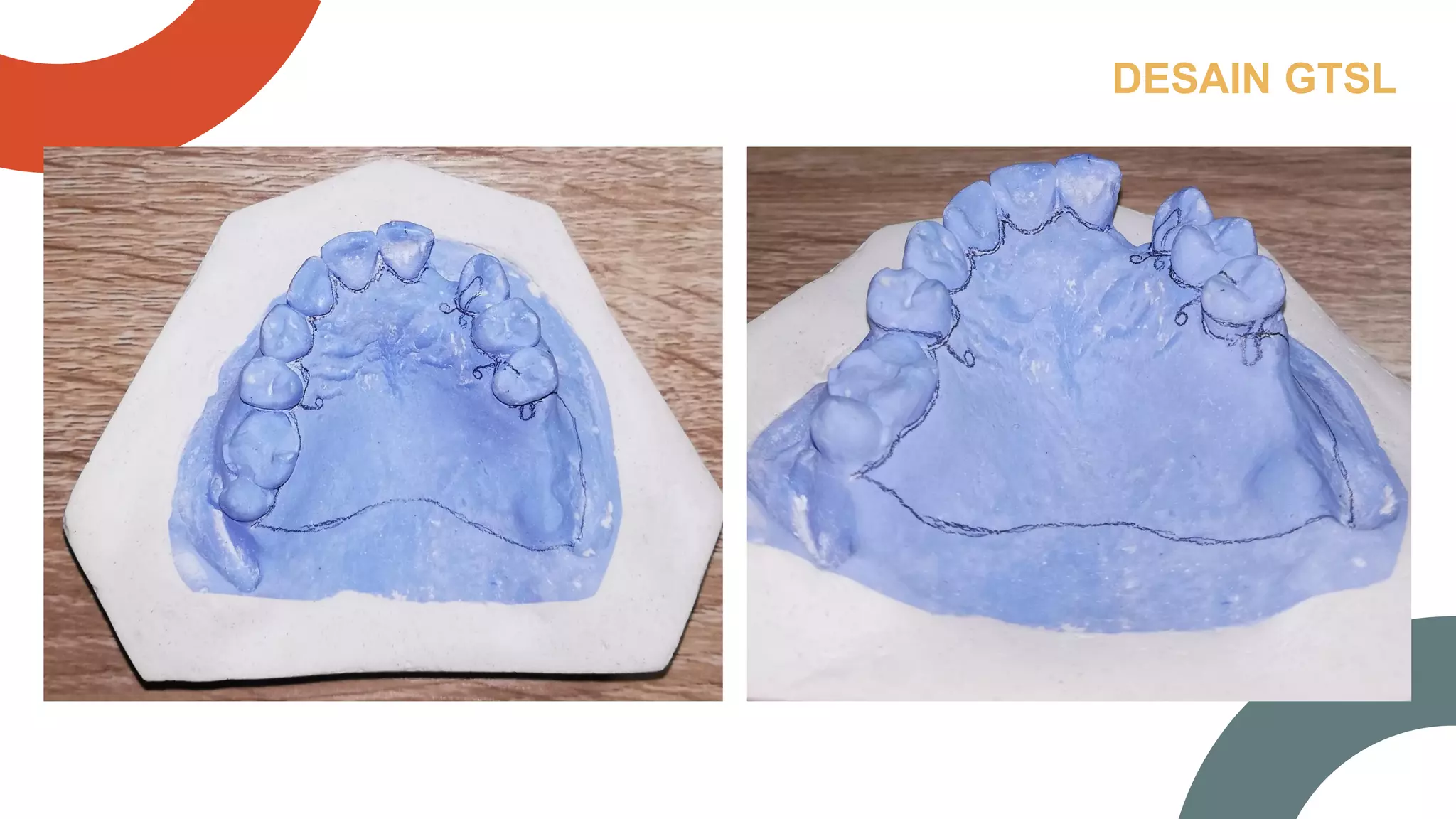 Laporan kasus gtsl | PDF