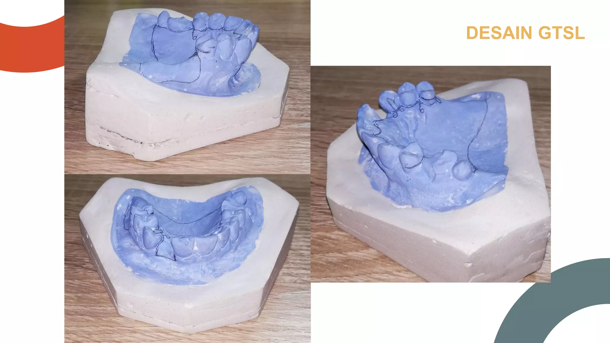 Laporan kasus gtsl | PDF