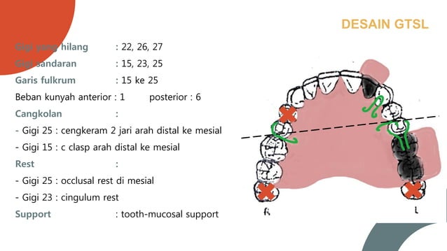 Laporan kasus gtsl | PPT
