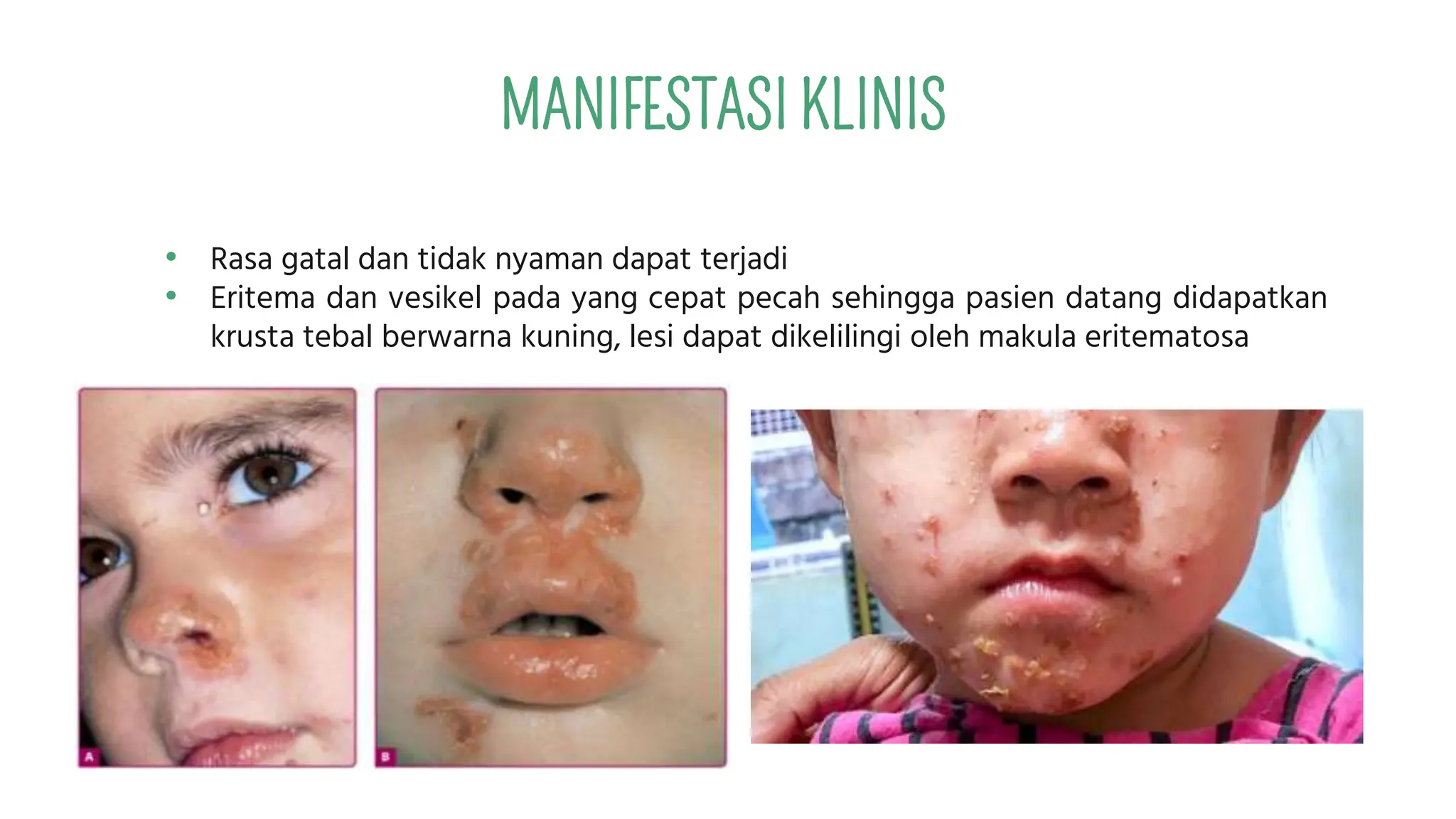 LAPORAN KASUS - IMPETIGO KRUSTOSA ISHIP.pptx