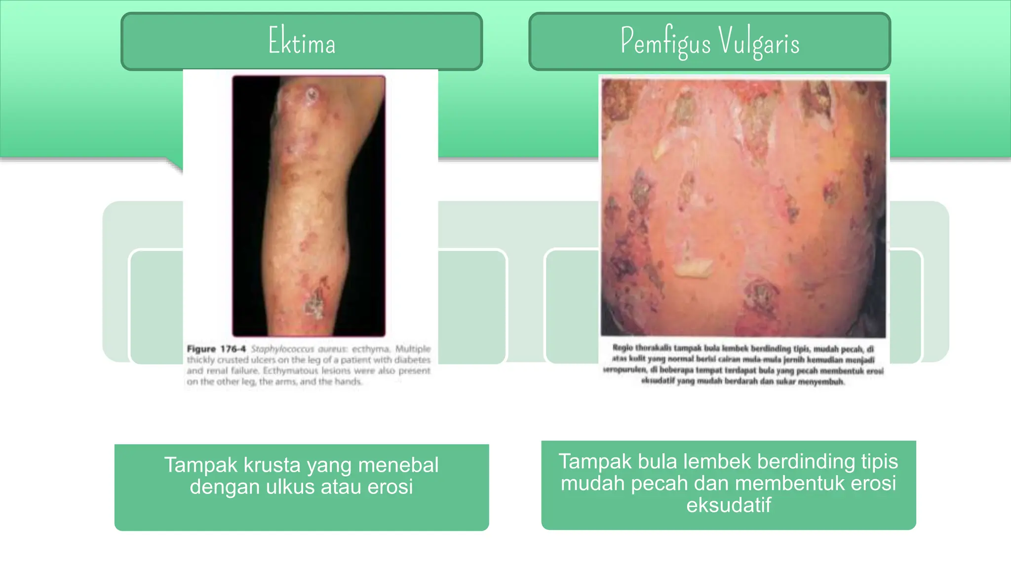 LAPORAN KASUS - IMPETIGO KRUSTOSA ISHIP.pptx