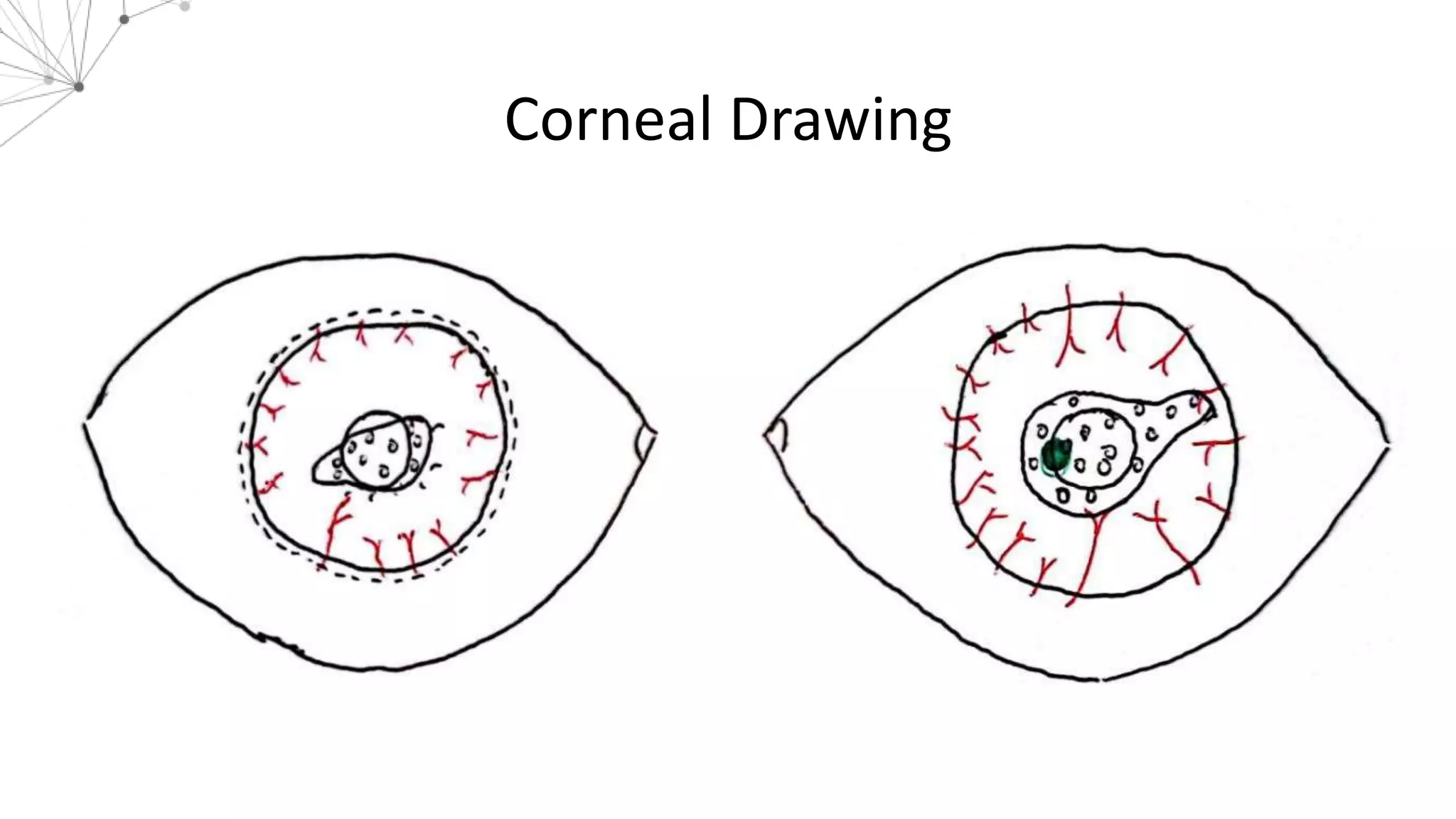 Laporan Kasus Corneal Distrophy-Muhammad Baqir IIM.pptx
