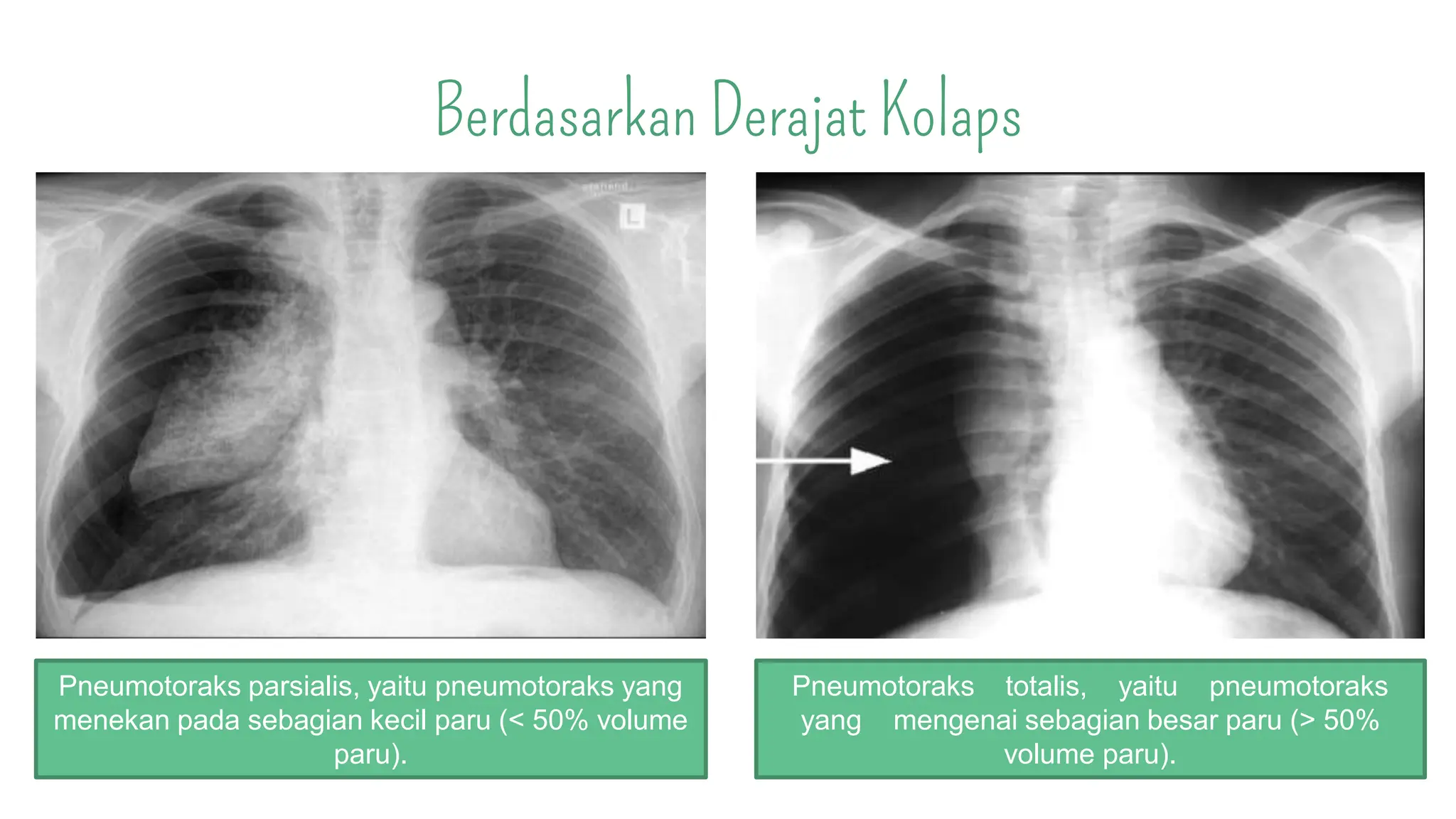 laporankasus-pneumothorax-231114120217-3822fc5b.pdf