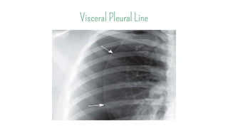 laporankasus-pneumothorax-231114120217-3822fc5b.pdf