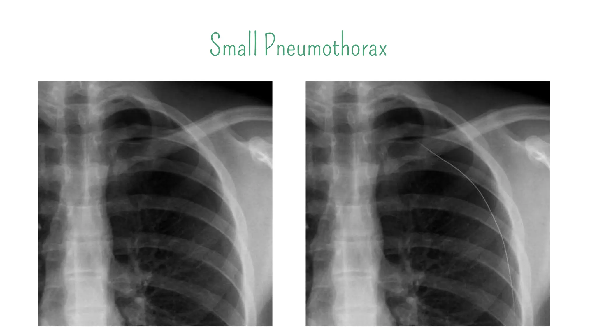 Laporan Kasus - Pneumothorax.pptx