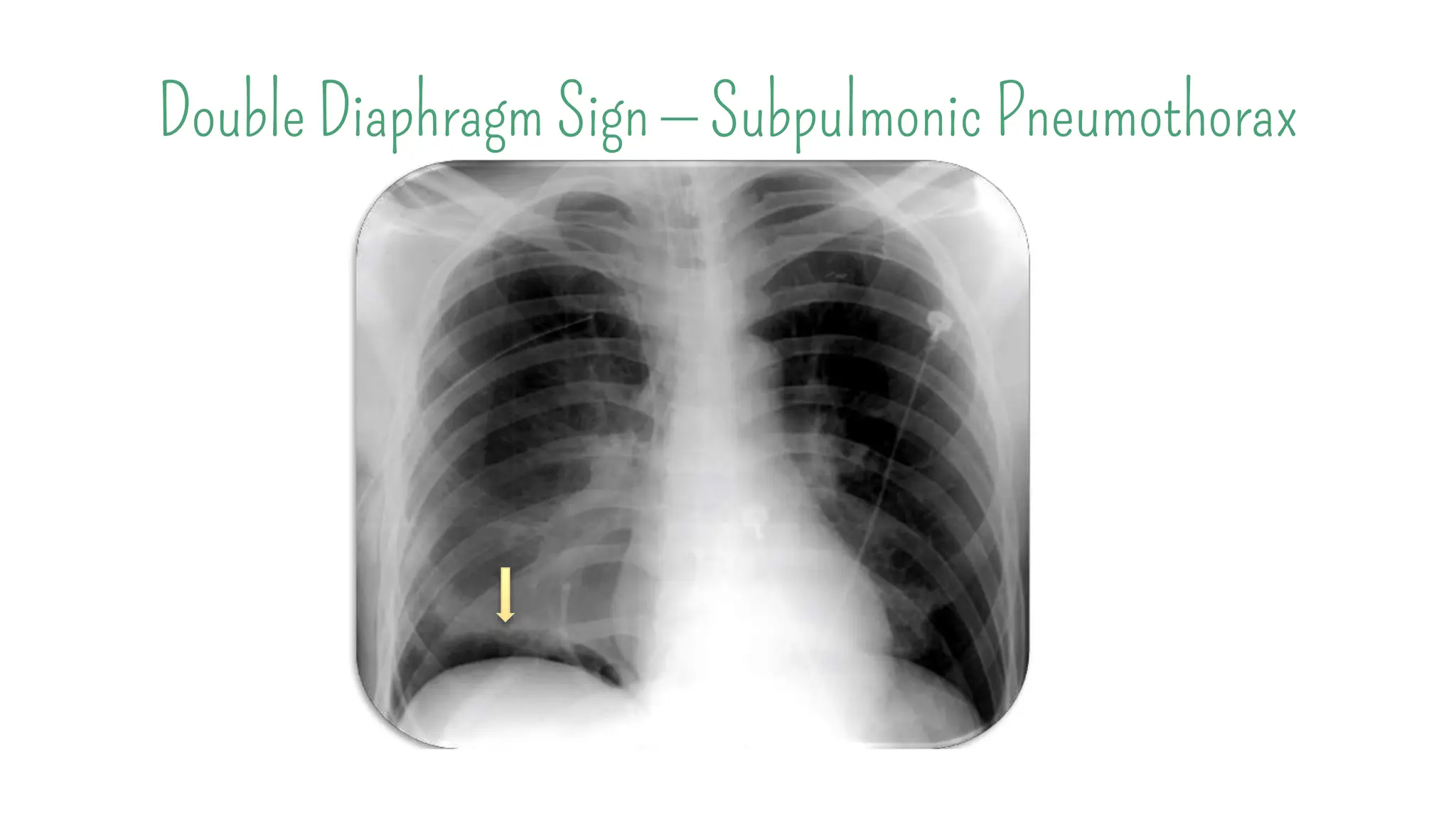 Laporan Kasus - Pneumothorax.pptx