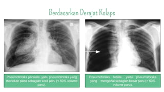 Laporan Kasus - Pneumothorax.pptx
