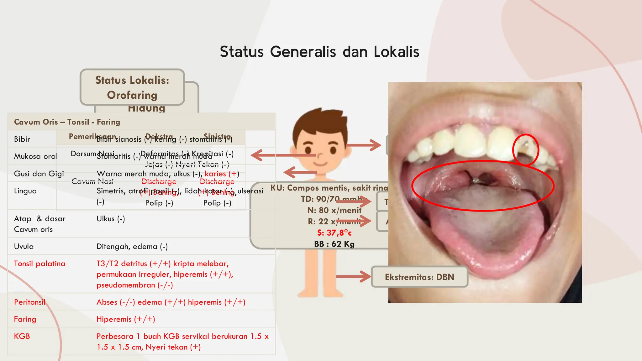 Laporan Kasus - Tonsilitis Kronik Eksaserbasi Akut.pptx