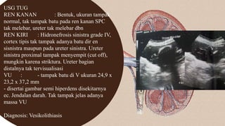 Laporan Kasus Vesicolithiasis di Rumah Sakit | PPTX