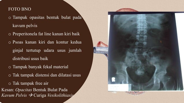 Laporan Kasus Vesicolithiasis di Rumah Sakit | PPT