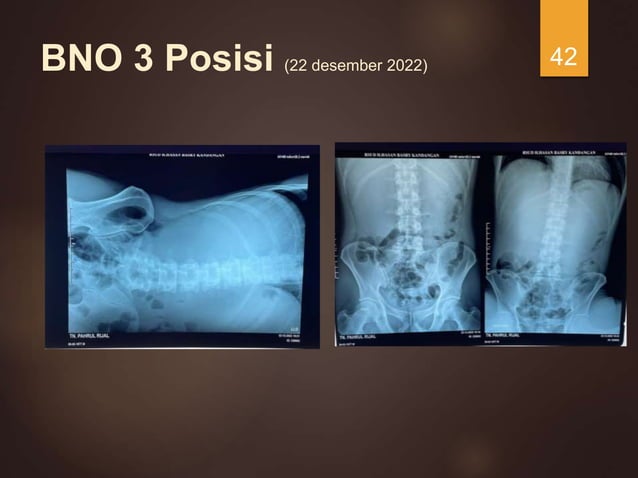 Laporan Kasus Abses Hepar-dr.pptx