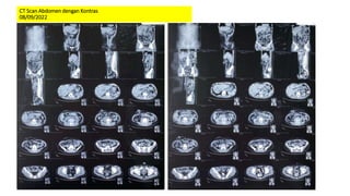 Laporan Kasus AdenoCa Colon Transversum.pptx