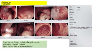 Laporan Kasus AdenoCa Colon Transversum.pptx