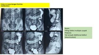 Laporan Kasus AdenoCa Colon Transversum.pptx