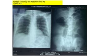 Laporan Kasus AdenoCa Colon Transversum.pptx