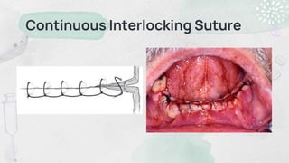 Laporan Kasus Alveolektomi.pptx