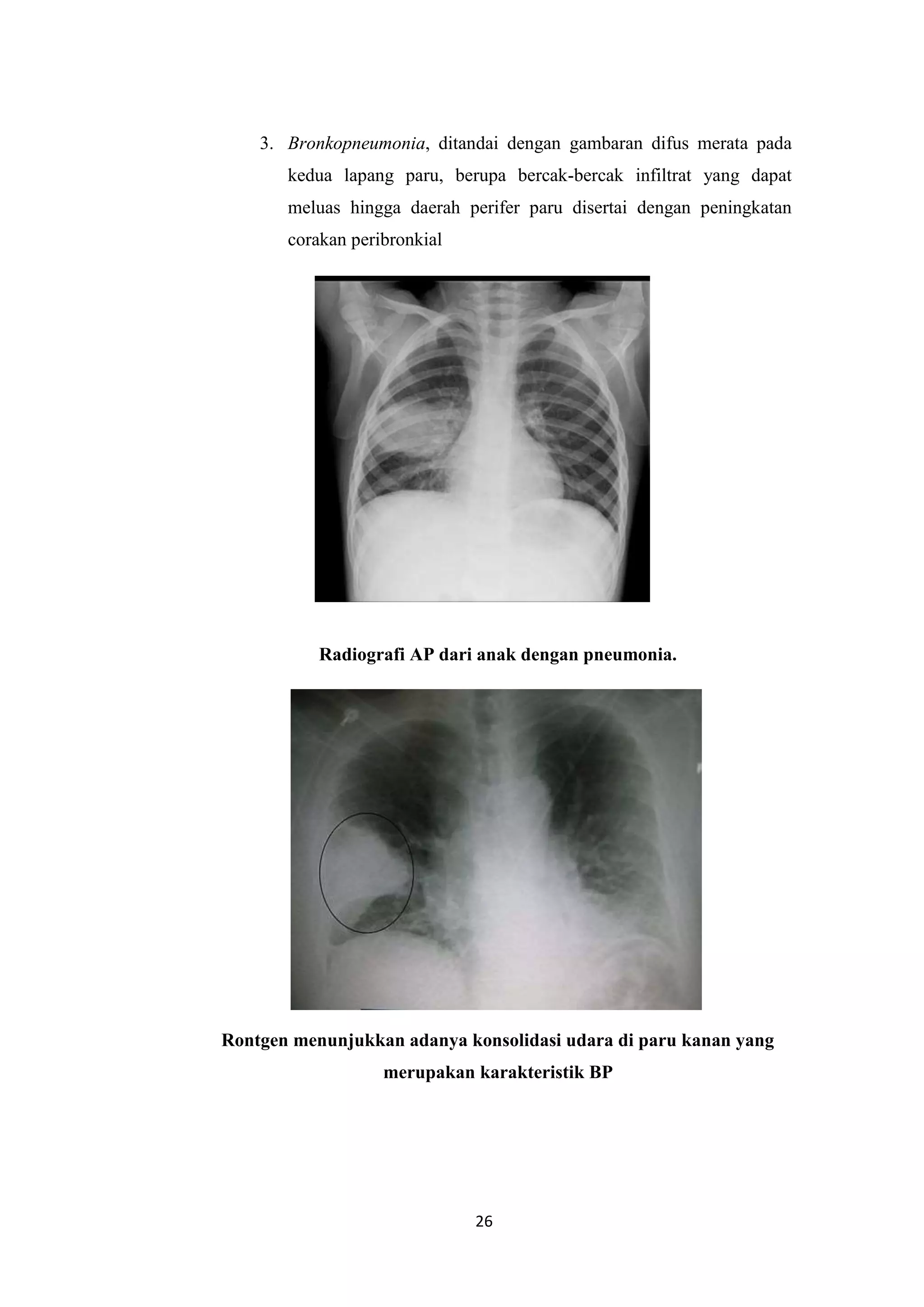 Laporan Kasus Bronkopneumonia Stase Anak (Aulia Dwi Juanita) | DOCX
