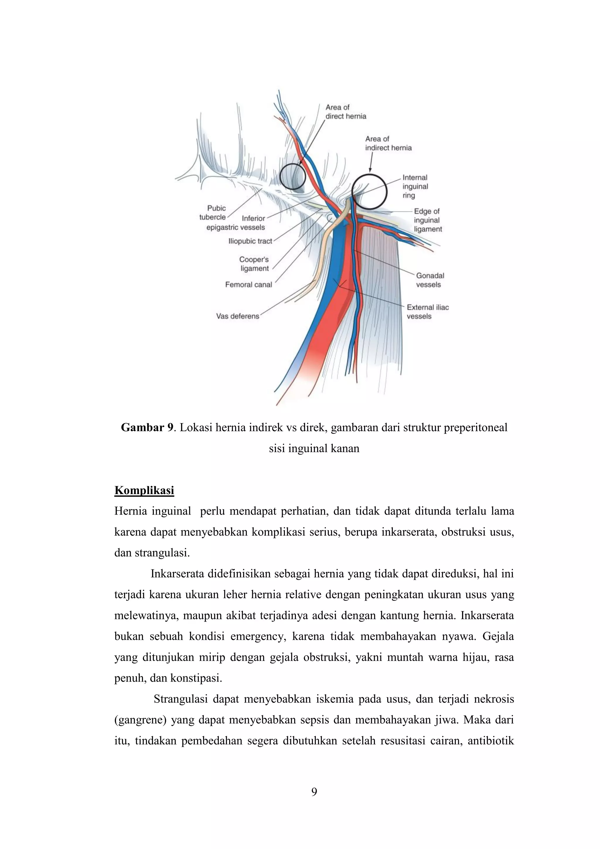 Laporan Kasus Bedah Anak : Hernia Inguinalis Lateralis Dekstra ...