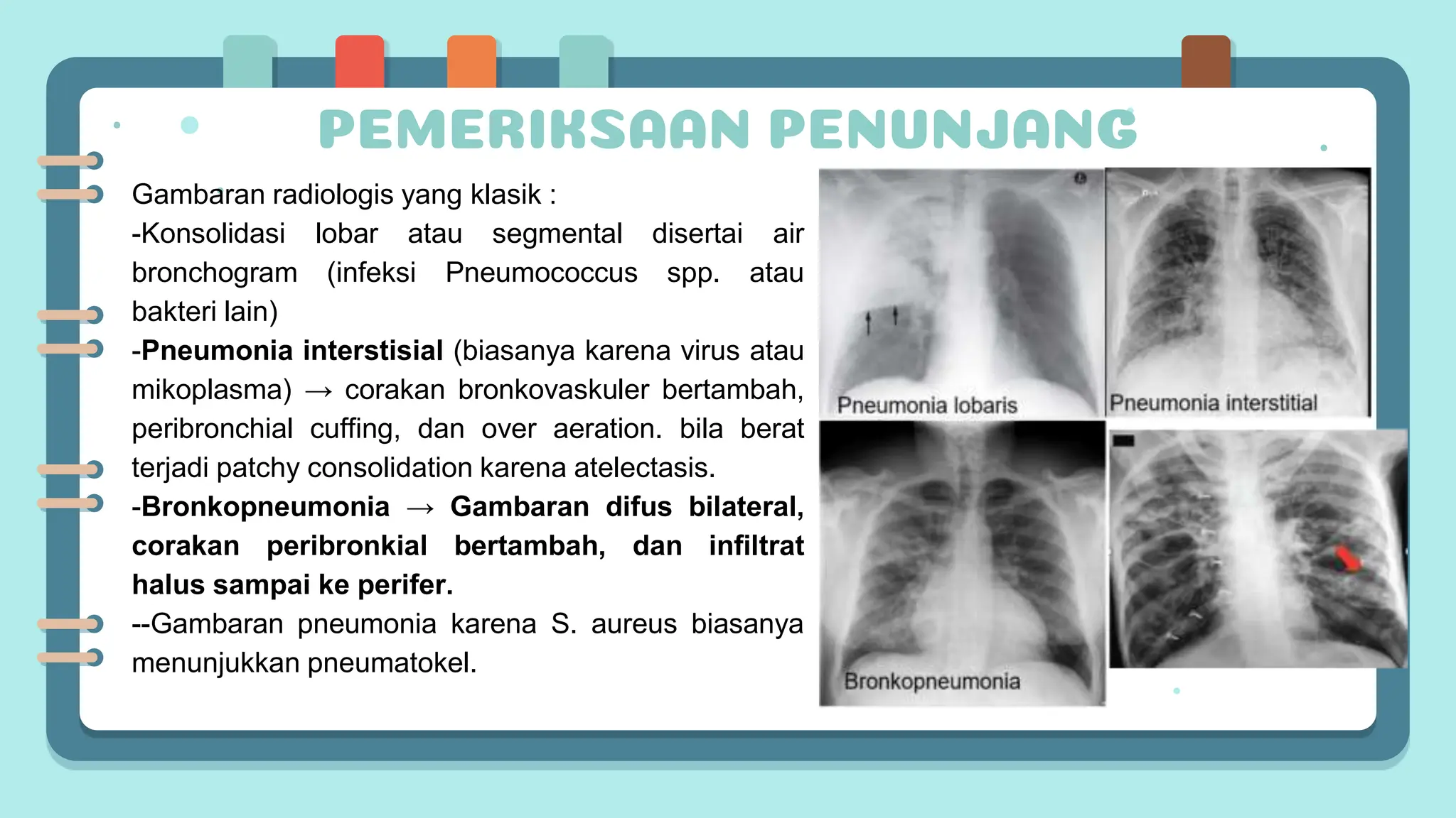 Laporan Kasus Bronchopneumonia Terbaru.pptx