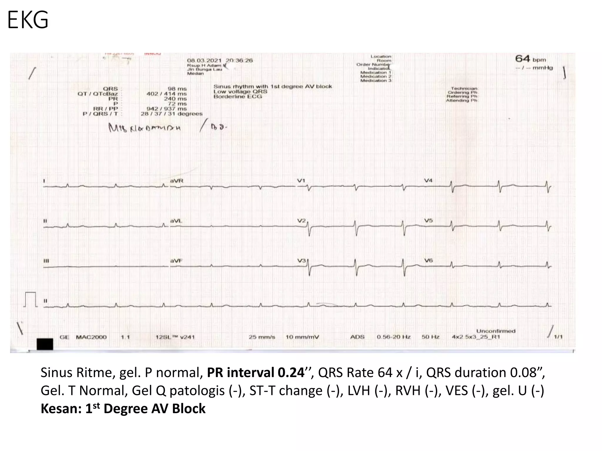 Laporan Kasus DVT.pptx