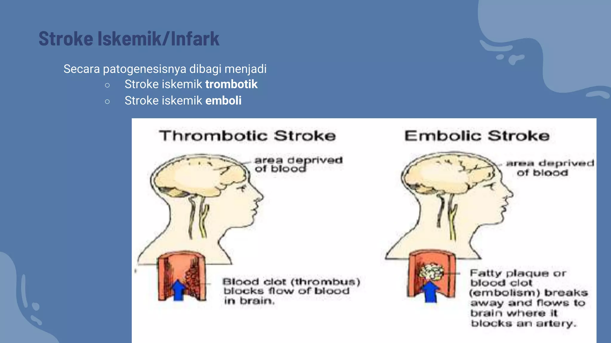 Stroke Infark.pptx