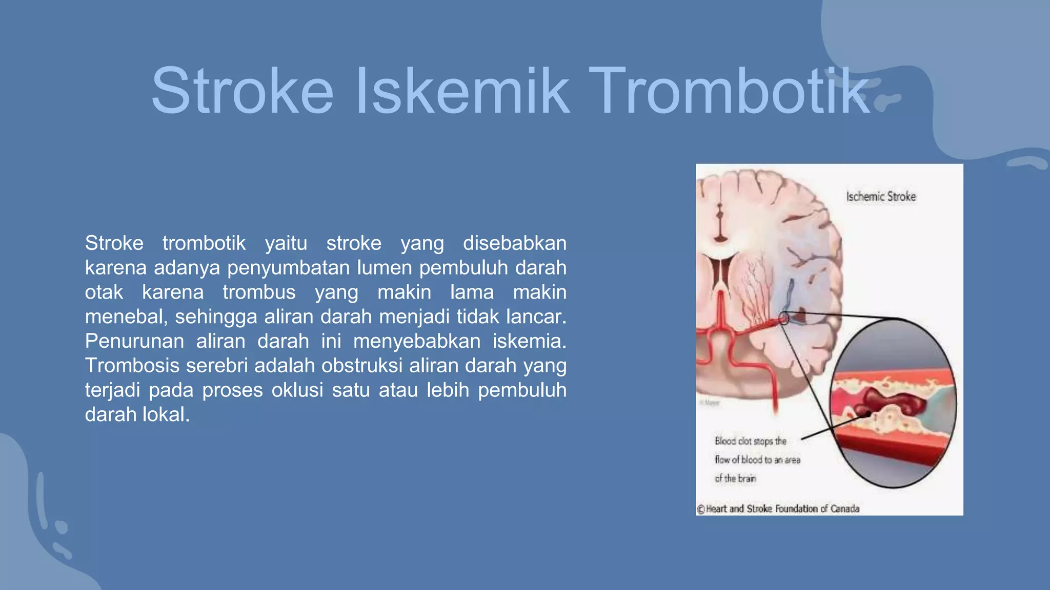 Stroke Infark.pptx