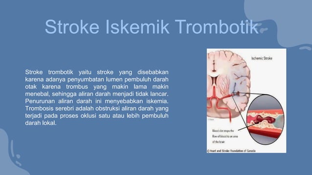 Stroke Infark.pptx
