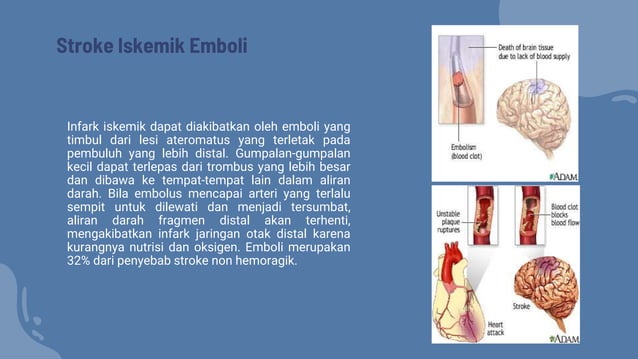 Stroke Infark.pptx