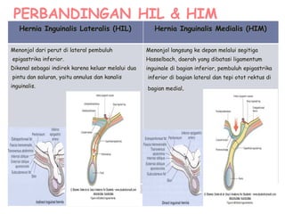 Laporan Kasus Hernia Inguinalis dextra.pptx