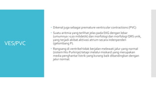Laporan Kasus Multiple Ventricle Extra Systole (mVES) | PPTX