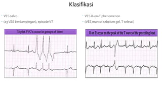 Laporan Kasus Multiple Ventricle Extra Systole (mVES) | PPTX