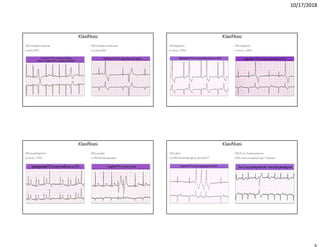 Laporan Kasus Multiple Ventricle Extra Systole (mVES) | PDF