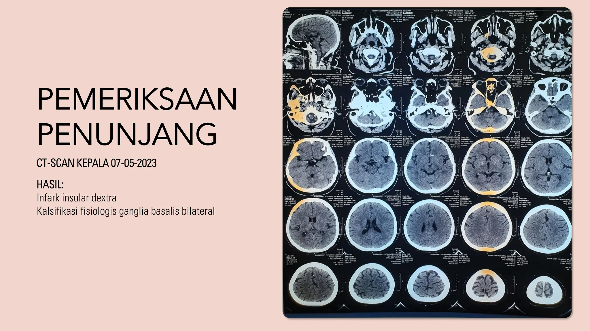 LAPORAN KASUS PADA PASIEN SROKE NON HEMORAGIC DENGAN DM TIPE 2.pdf