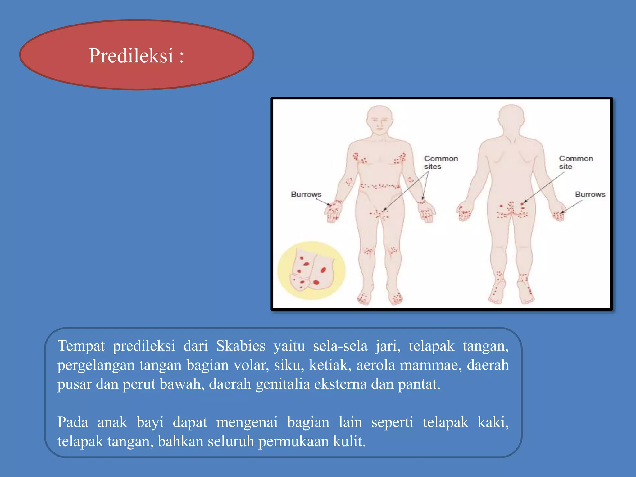 Laporan kasusScabies | PPTX