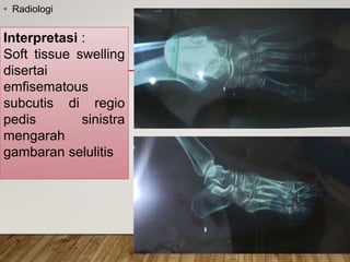 LAPORAN KASUS SELULITIS RSUD WAMENA_075010-1.pptx