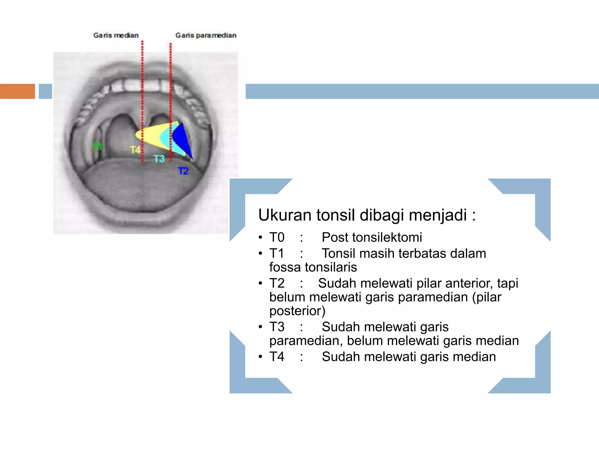 LAPORAN KASUS tonsiltis.pptx