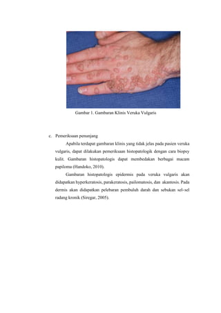 LAPORAN KASUS VERUKA VULGARIS FATTIA PRATIWI 22360180.docx