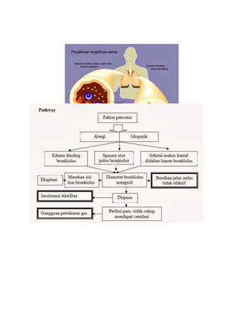 Laporan pendahuluan asma | DOCX
