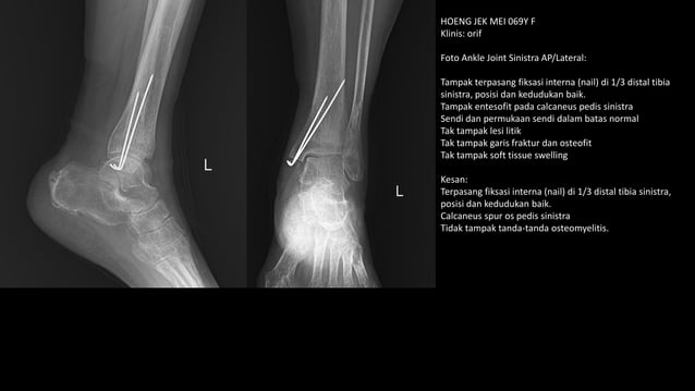 Laporan Stase Muskuloskeletal 5 Juni 2024.pdf
